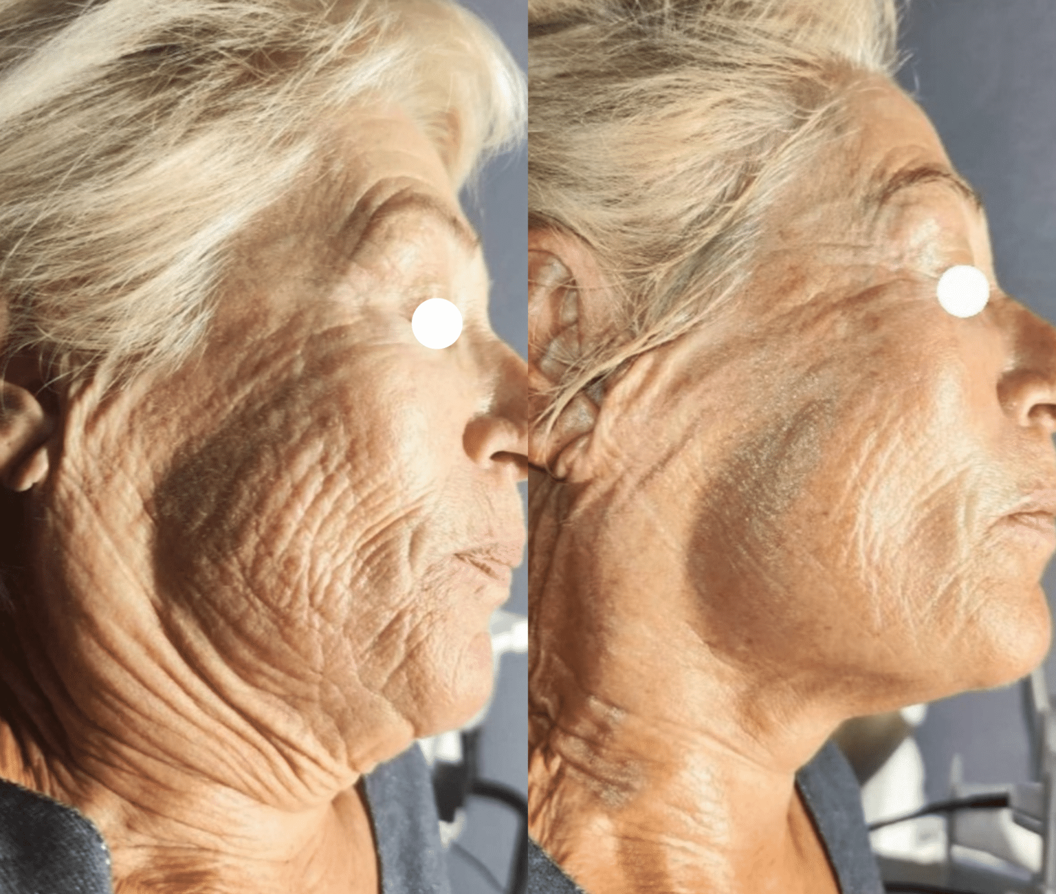 NeoCare Elite, the Face & Bodycontouring revolution - Bloomea