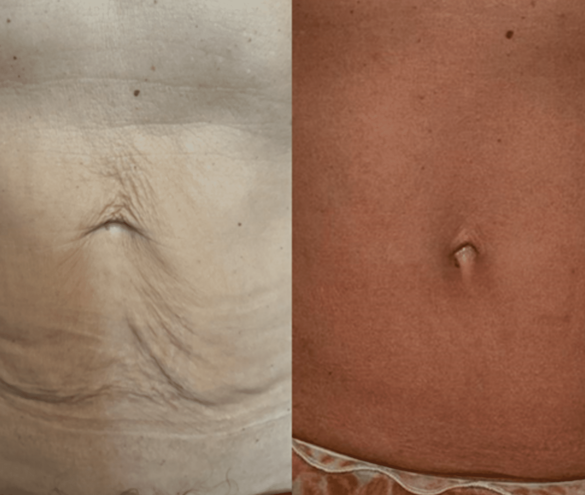 NeoCare Elite, the Face & Bodycontouring revolution - Bloomea